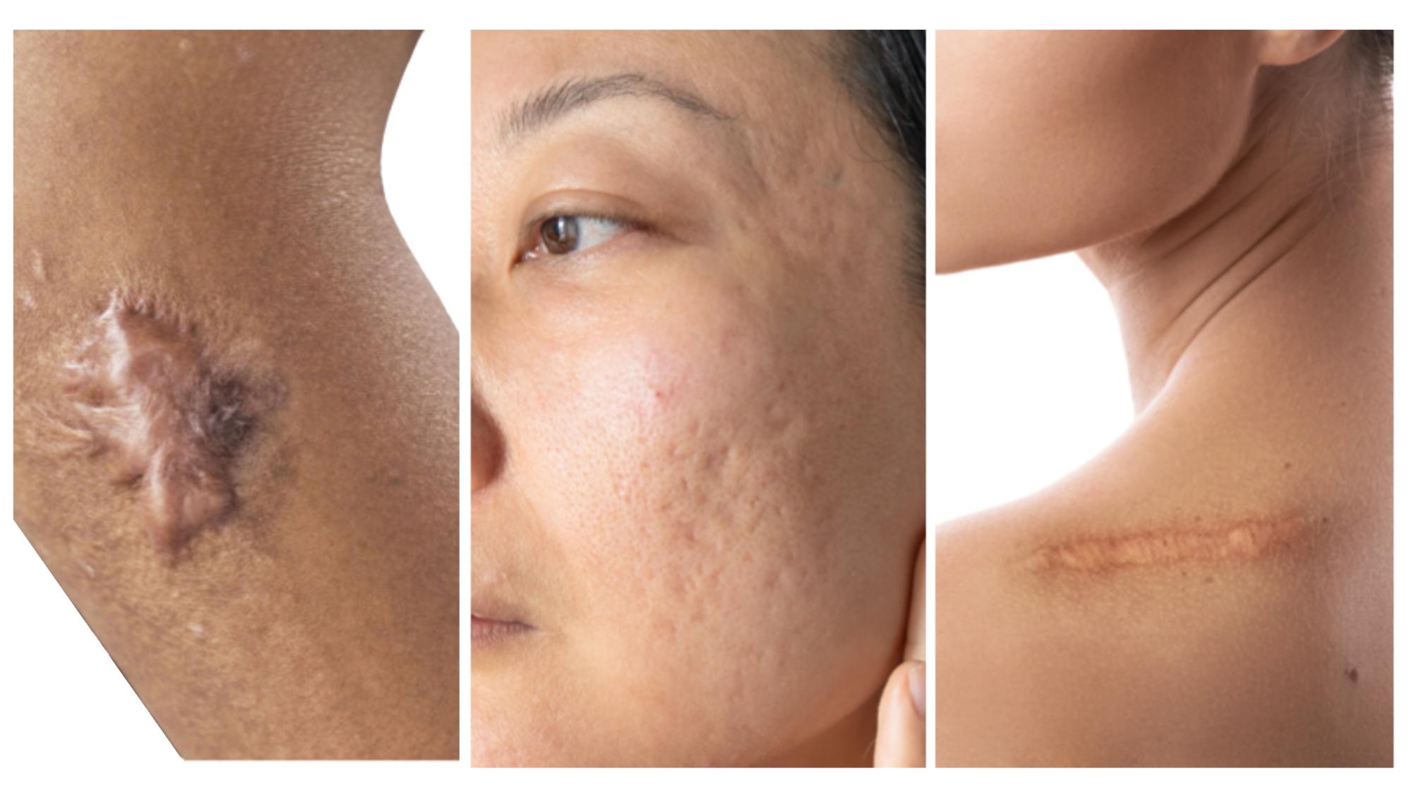 Scar Treatment in Santa Rosa, CA - Chernoff Cosmetic Surgery