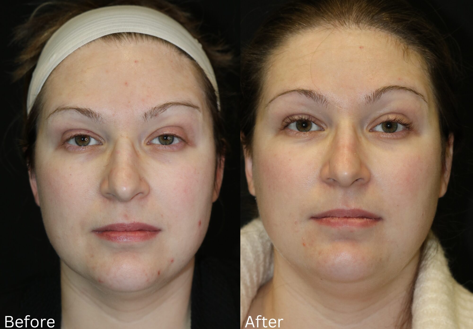 SaltFacial Before & After | Dr. Gregory Chernoff
