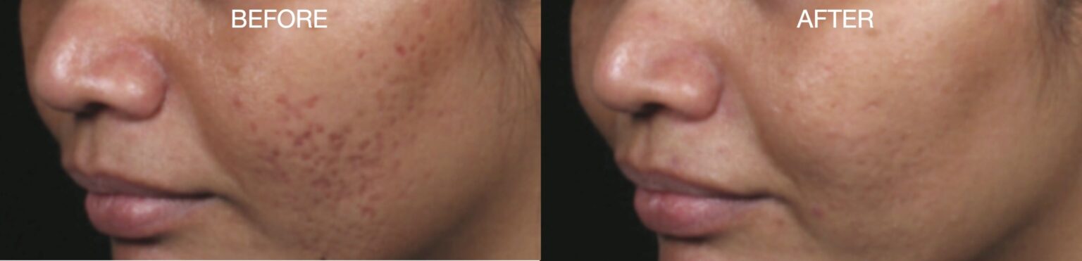 INTRAcel - Dr. Chernoff Plastic Surgery